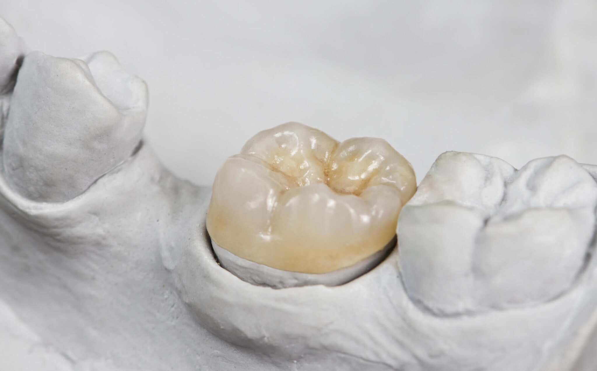 Inlays and Onlays - HFC Dentistry